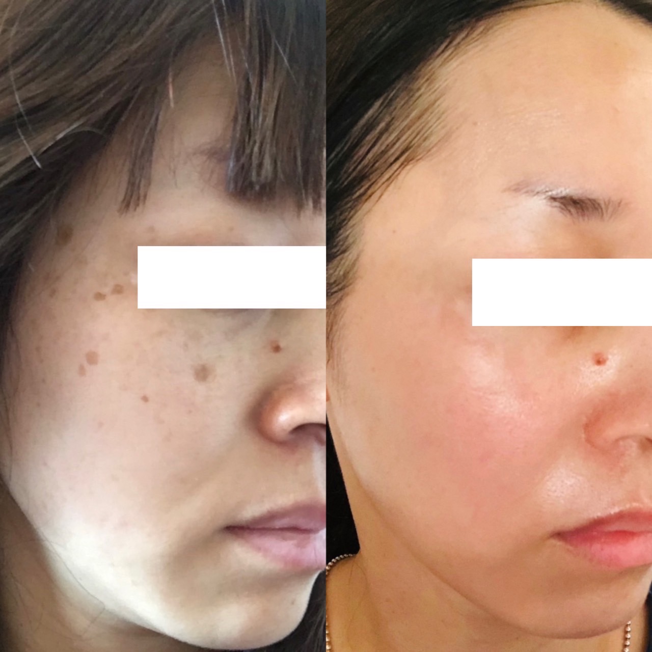 フェイシャルメニュー - ARuru - 滋賀県甲賀市水口、甲南、南草津、京都府山科に4店舗を構えるエステサロン、ARuruは、本気で肌改善に ...