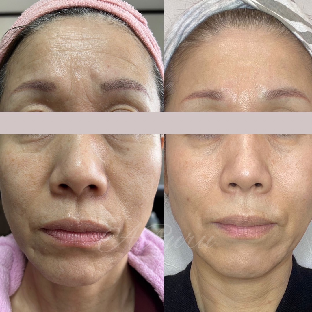 フェイシャルメニュー - ARuru - 滋賀県甲賀市水口、甲南、南草津、京都府山科に4店舗を構えるエステサロン、ARuruは、本気で肌改善に ...